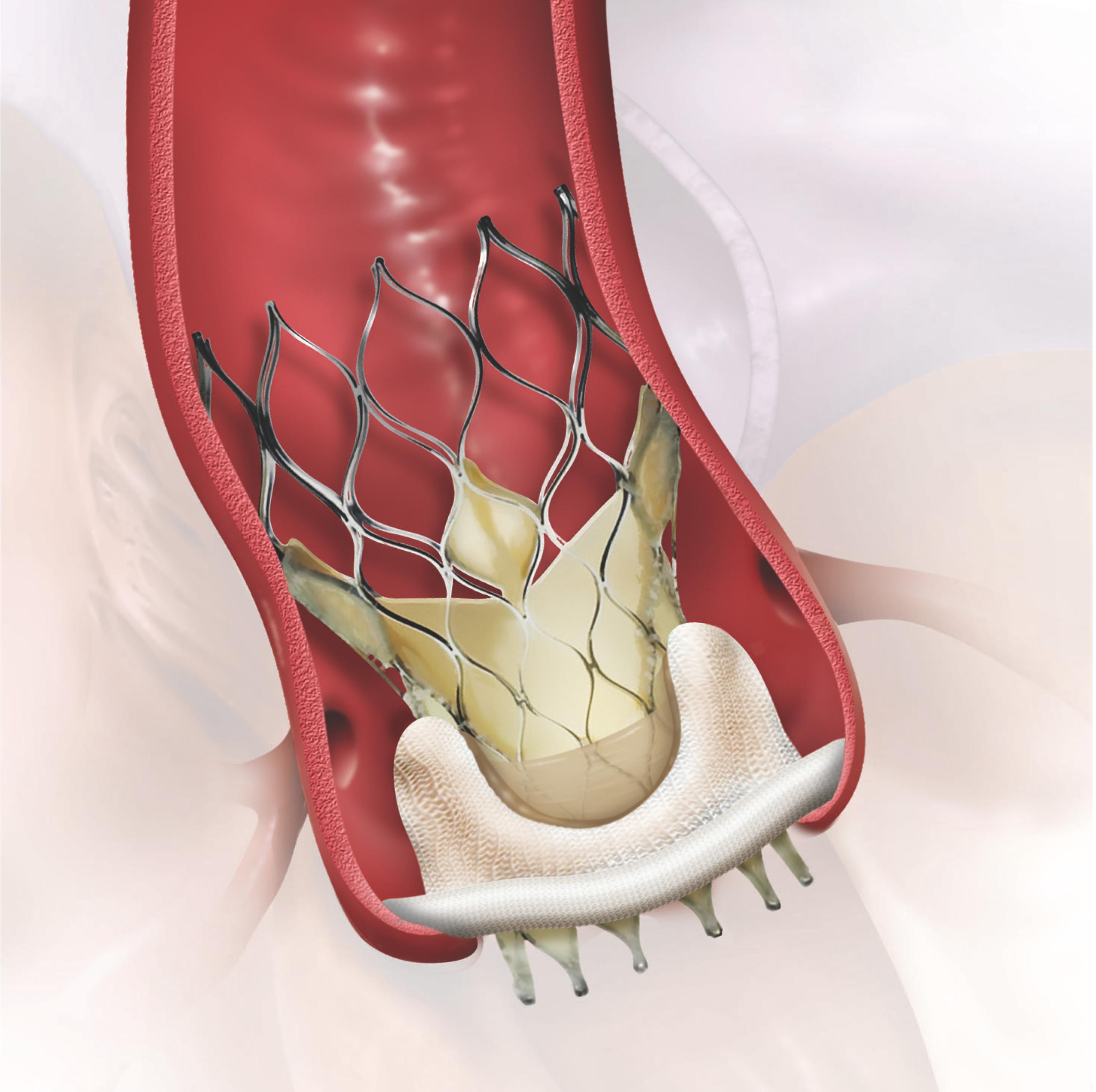TAVI「経カテーテル大動脈弁植え込み術」|新東京病院